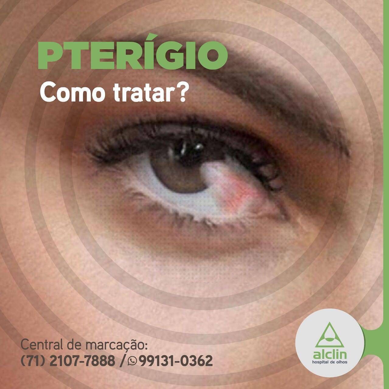 O pterígio, geralmente, não requer tratamento, se os sintomas forem ...